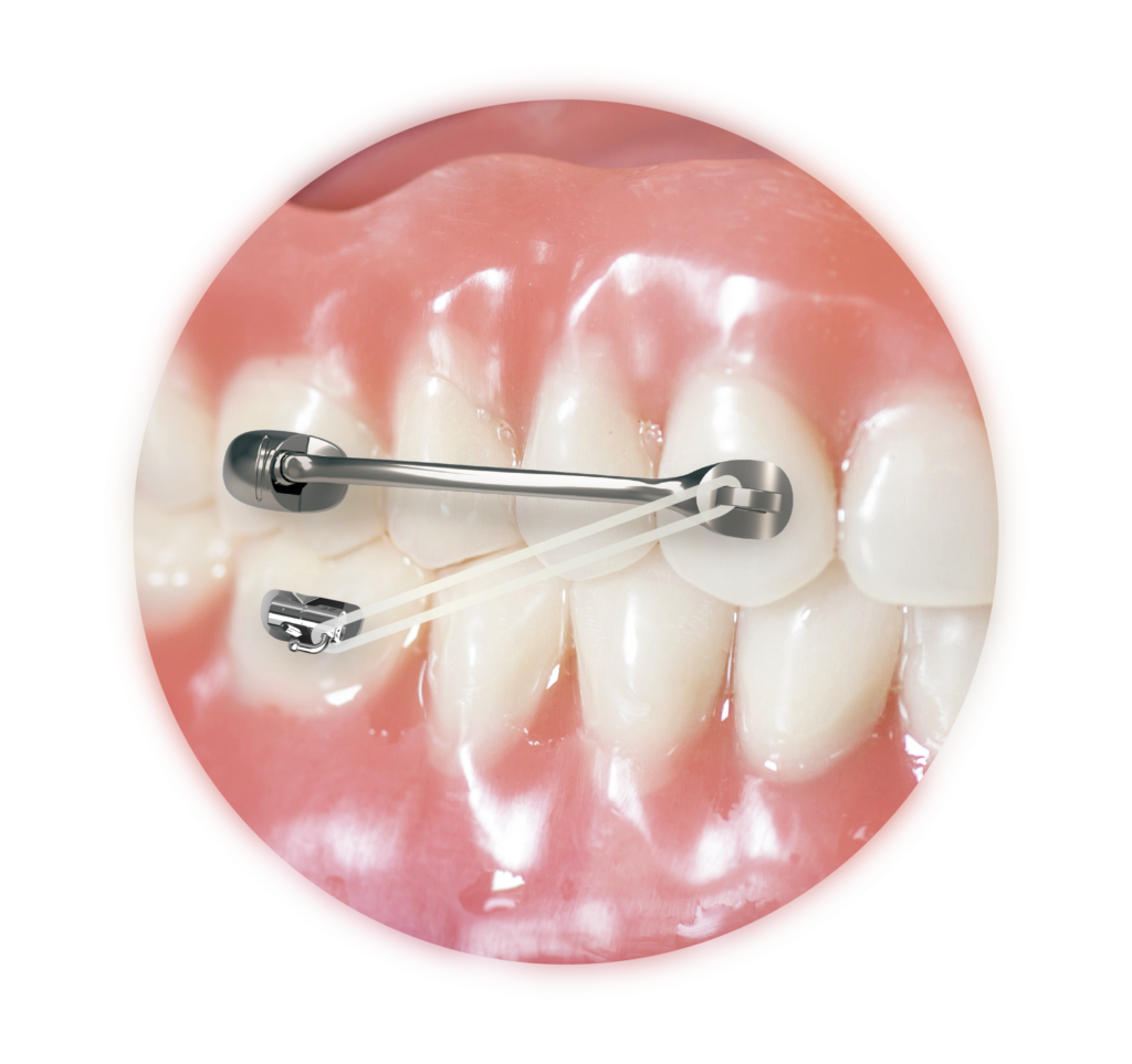 Fastrack Class II Appliance Transform Your Practice with